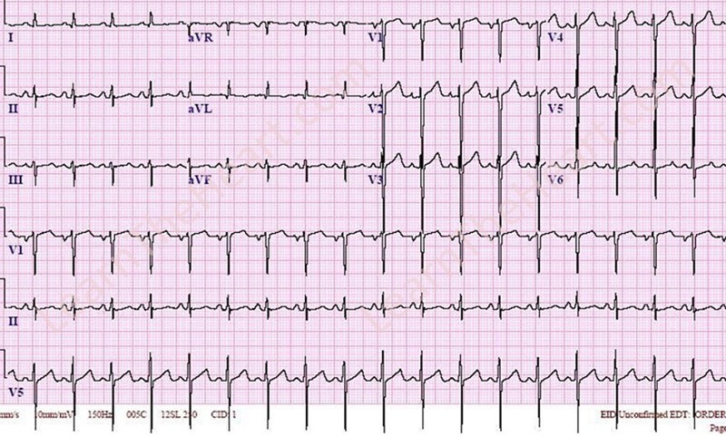 Atrial Arrhythmias ECG 13 | Learn the Heart