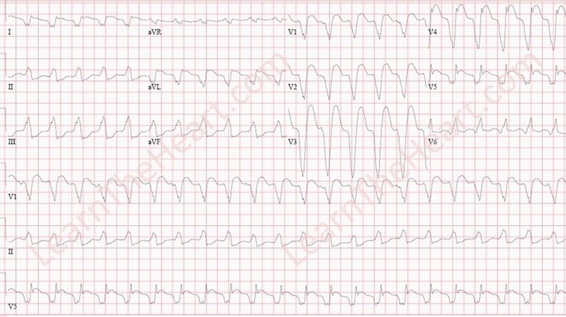 Monomorphic Sustained Ventricular Tachycardia ECG (Example 5) | Learn ...
