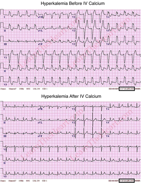 Hyperkalemia ECG Review | Learn the Heart