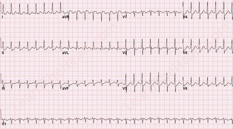 AV Nodal Reentrant Tachycardia (AVNRT) ECG (Example 1) | Learn the Heart