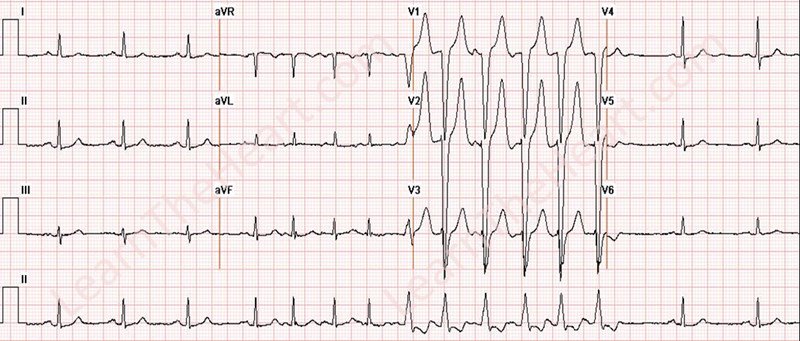 Rate Dependent Left Bundle Branch Block ECG | Learn the Heart